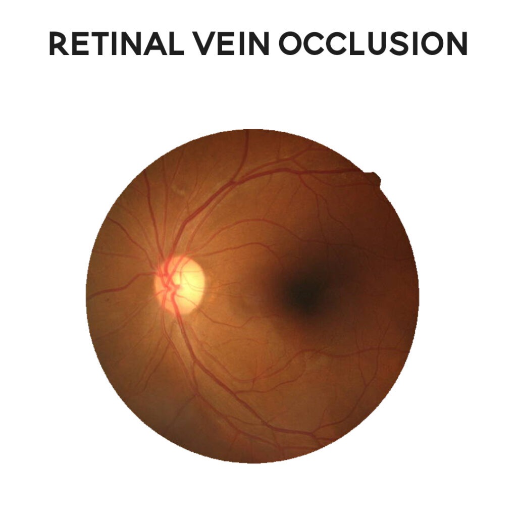 Retinal Vein Occlusions Services in Patiala at Dr Harsh Inder