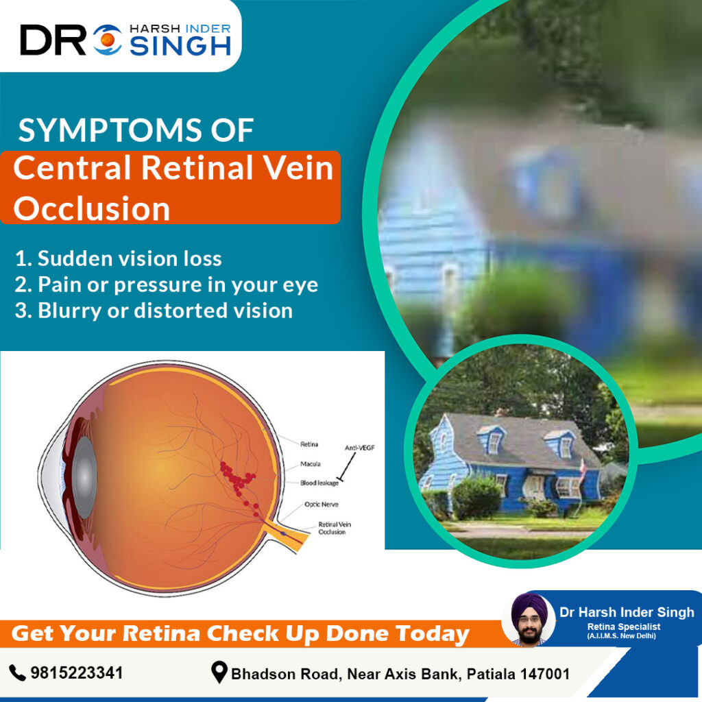 How Retinal Vein Occlusion Affects Vision