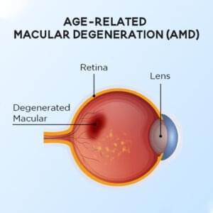 Age-Related Macular Degeneration - Dr. Harsh Inder Singh Retina Center